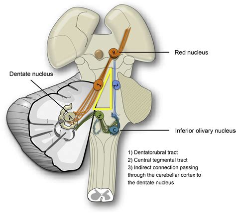 Imaging Secondary Neuronal Degeneration Radiología English Edition