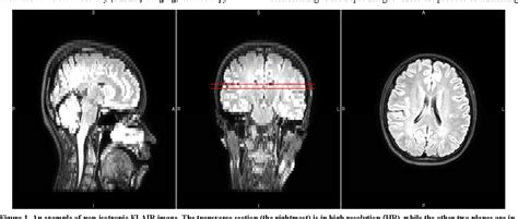 Figure 1 From 3d Super Resolution For Non Isotropic Medical Image