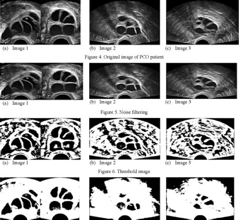 Table 1 From Ultrasound Image Segmentation Using A Combination Of Edge Enhancement And Kirschs