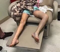 7歲女童被響尾蛇咬沒發現腿部發紫急送醫 打40瓶血清救回一命 tortoisetttt的創作 巴哈姆特