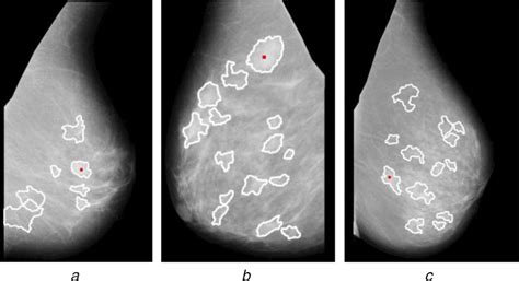 Segmentation Results In Mammograms From Mini‐mias Database For Download Scientific Diagram