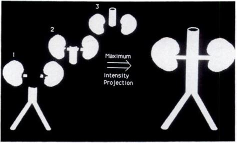 Schematic Of Maximum Intensity Projection Algorithm As Applied To