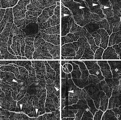 Motion Artifacts Optical Coherence Tomography At Isabella Jolly Blog