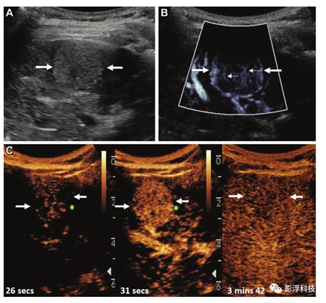 2022年第83期 radiology） 微血管血流成像：临床应用现状和前景 微血流成像是看什么的 「已注销」的博客 csdn博客