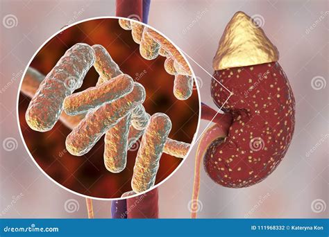 Pyelonephritis Medical Concept And Close Up View Of Bacteria The Common Causative Agent Of