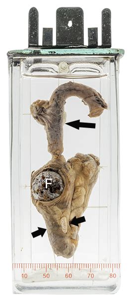 50 Appendicitis With Fecalith Maude Abbott Medical Museum Mcgill