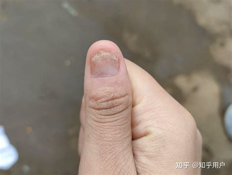 治疗灰指甲的亲身经历 知乎