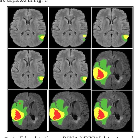 Figure 1 From Automatic Detection Of Brain Tumor From Ct And Mri Images Using Wireframe Model