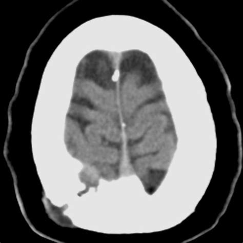 Axial Nonenhanced Ct A Hyperdense Extra Axial Mass In The Right