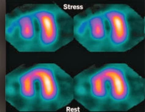 Technetium 99m Isotope Research Assignment Technetium 99m