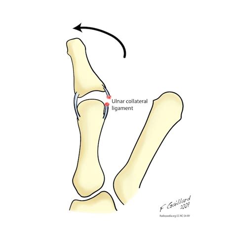 Occupational Fractures Pacs