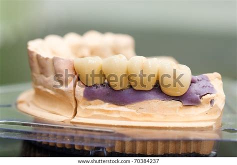 Fixed Partial Denture Dental Bridge On Foto Stock Shutterstock