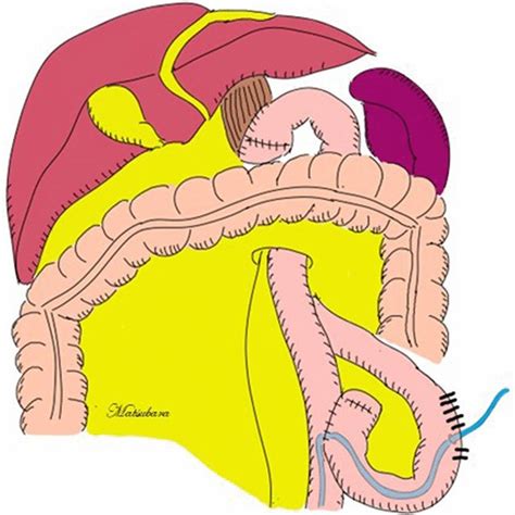 Surgical Schema Of Jejunostomy Feeding Tube A Jejunostomy Feeding Tube