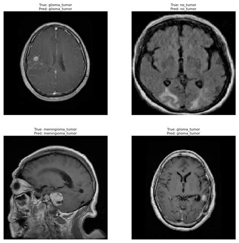Advancing Brain Tumor Detection Harnessing The Swin Transformers Power For Accurate