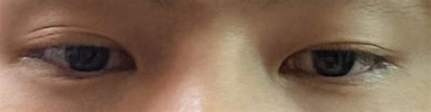 눈꺼풀 한쪽에 주름이 생기고 부은 것 같아요 지식in
