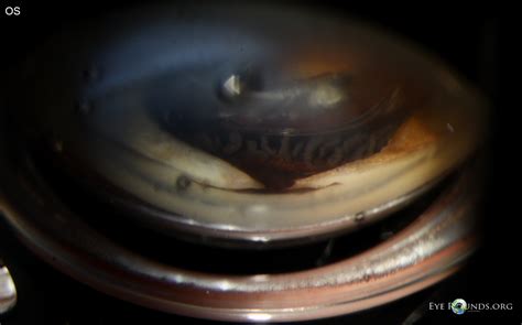 Gonioscopy Iris Processes
