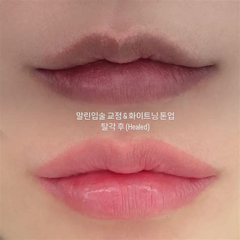 강남입술문신 입술문신 입술반영구 립라인 입술문신수강 アートメイク 로제이뷰티아카데미 대표원장 🕋 입술문신에서 가장 중요한 건 탈각 후 👄 깨끗한 입술 바탕을 위해
