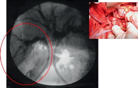 Intraoperative Cholangiography Download Scientific Diagram