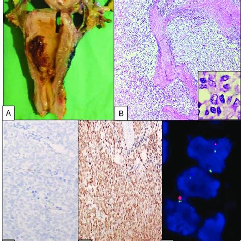 High Grade Endometrial Stromal Sarcoma A Gross Photo Polypoidal Download Scientific Diagram