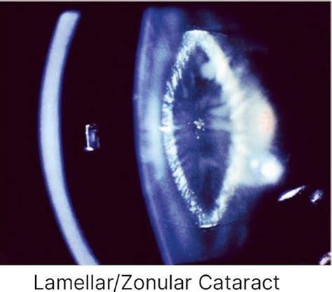 Guide To Cataracts Types Causes Treatment And More