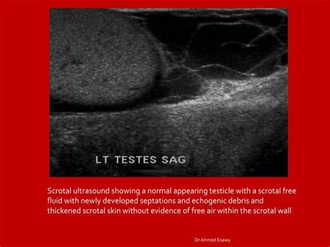 Imaging Orchitis Epidydmitis Epidydmo Orchitis Drahmed Esawy Pdf Reproductive Health