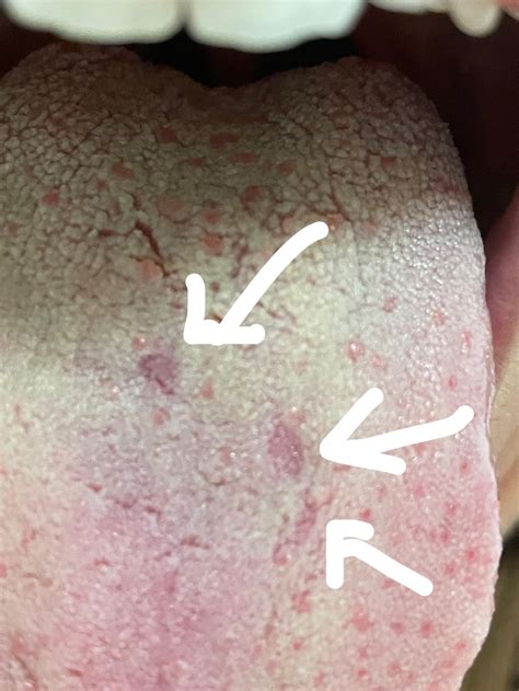 Red Patches On Tongue Rmouthcancer