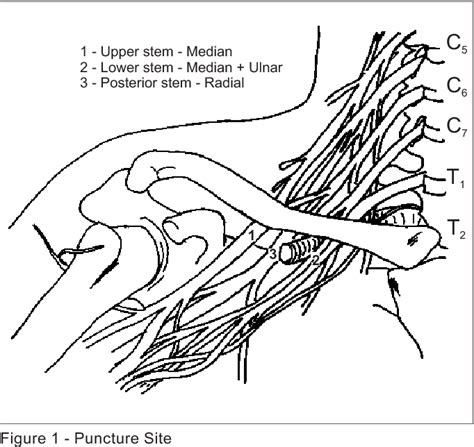 Figure 1 From Infraclavicular Brachial Plexus Block Antero Posterior Approach Semantic Scholar