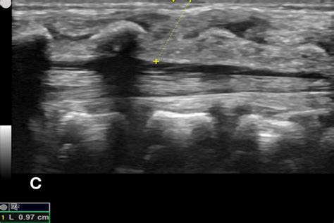 Ultrasound Assisted Lumbar Puncture In Infants Em Ultrasound Section