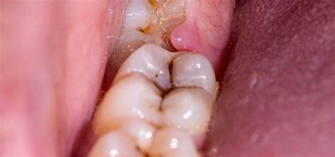 Pulling A Molar Tooth