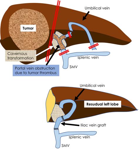 A Schema Of This Operation Is Shown The Main Trunk Of The Portal Vein