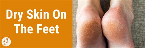 Cracked Dry Skin How To Repair Cracked Heels Fasa