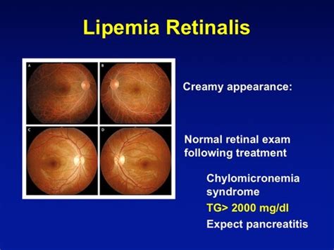 Lipemia Retinalis