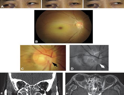 Central Retinal Artery Occlusion Caused By Fat Embolism Foll