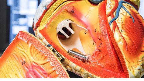 Pill Sized Pacemaker A Big Step Forward Itv News