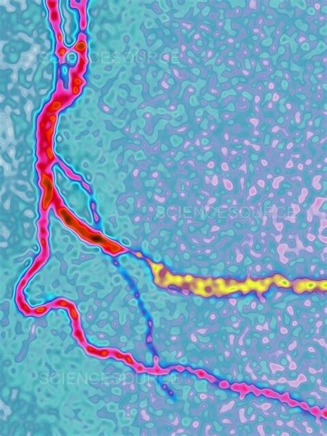 Photograph Myocardial Infarction Angiogram Science Source Images