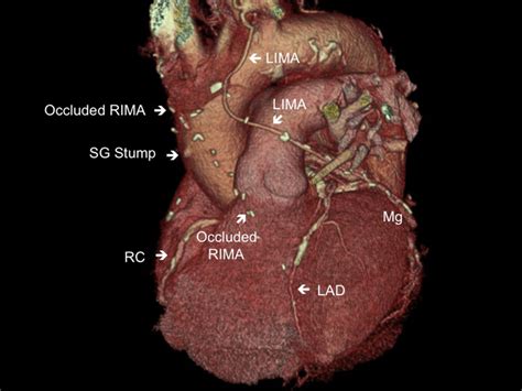 64 Detector Ct Volume Rendering Reconstruction Of Patient With Three