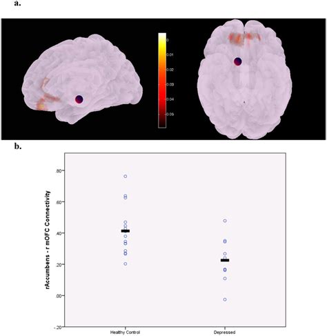 Illustration Of Areas In The Medial Orbitofrontal Cortex With Decreased Download Scientific