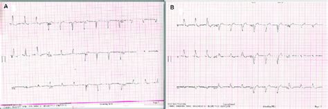 The Exercise Test Showed The Sudden Change Of QRS Morphology To Left Download Scientific