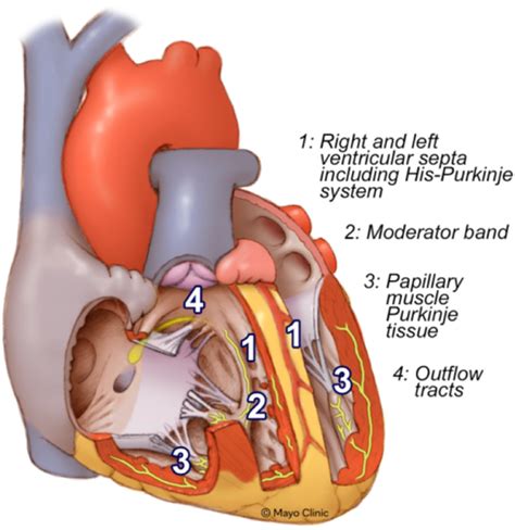Locations Of Premature Ventricular Contractions Pvcs That Can Trigger