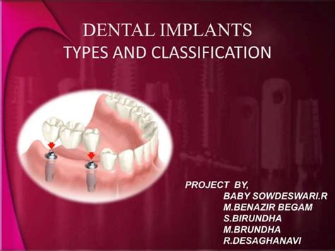 Types And Classification Of Dental Implants Pptx Operating Systems