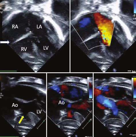 Echocardiogram In The Apical 4 Chamber View A With Color Doppler B