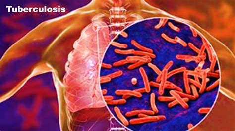 Vistow On Linkedin Who Approves New Tb Test To Help Fight Drug