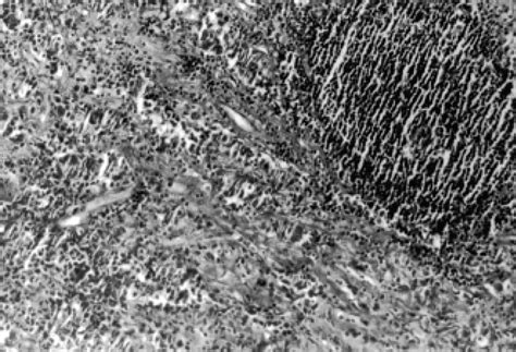Lymphocytic Adenohypophysitis Forming Follicle And With Aviable