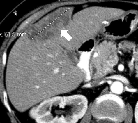 Stage T1b Intrahepatic Cholangiocarcinoma An Axial Contrast Enhanced