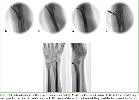 Figure 1 From Closed Reduction And Percutaneous Pinning Versus Dorsal Entry Elastic