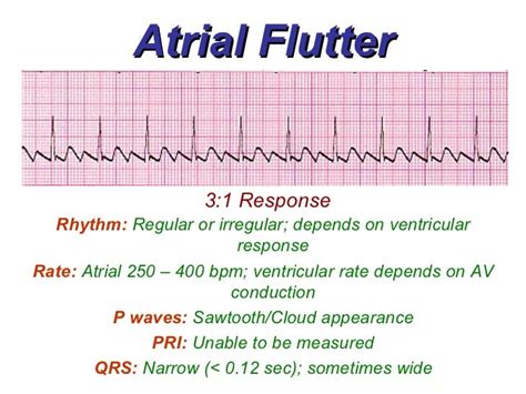 3a Atrial Rhythms
