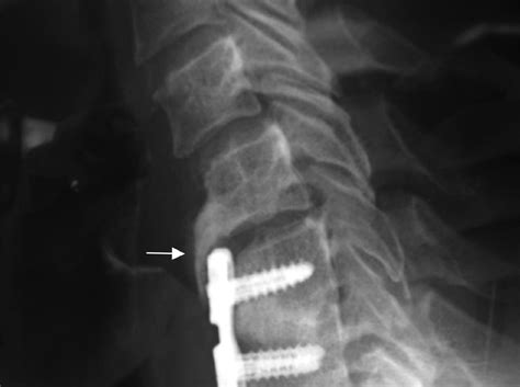 Cervical Adjacent Segment Disease Spine Orthobullets