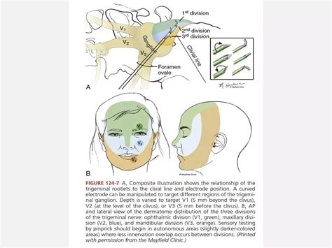 Trigeminal Neuralgia Pptx Ear Nose And Throat Conditions Diseases And Conditions Trigeminal Neuralgia Pptx Ear Nose And Throat Conditions Diseases And Conditions