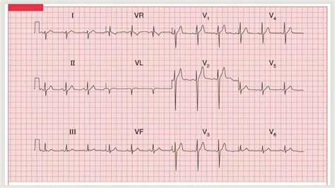 Cardiac Axis Simplified Pptx