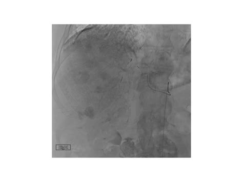 Radioembolization Induced Liver Disease A Brief And Limited